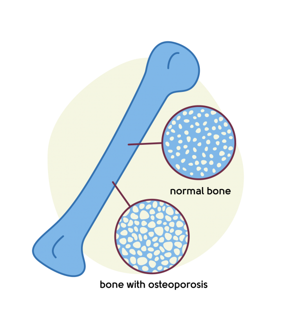 Menopause Symptoms | Osteoporosis | My Menopause Centre