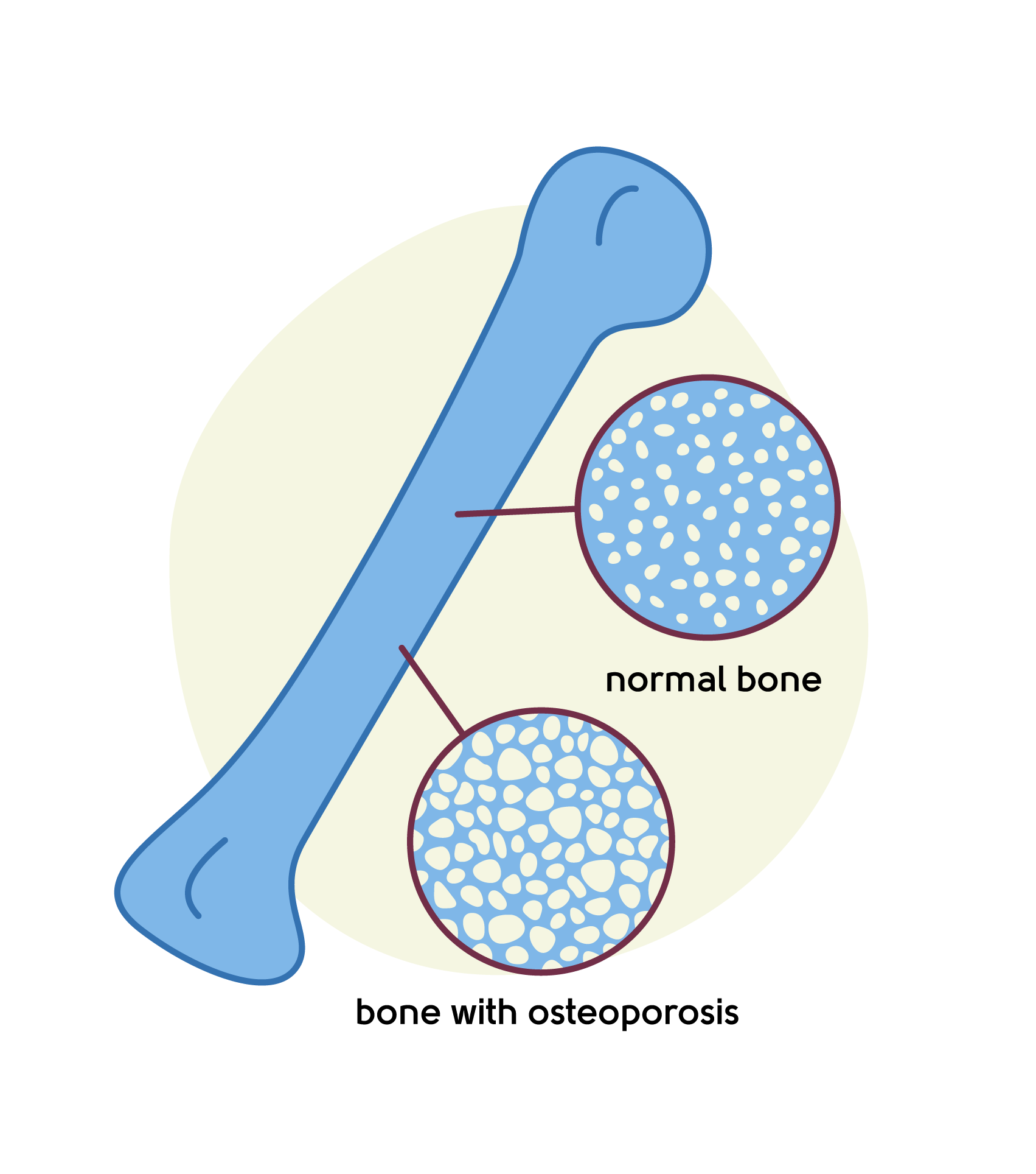 Menopause Symptoms | Osteoporosis | My Menopause Centre